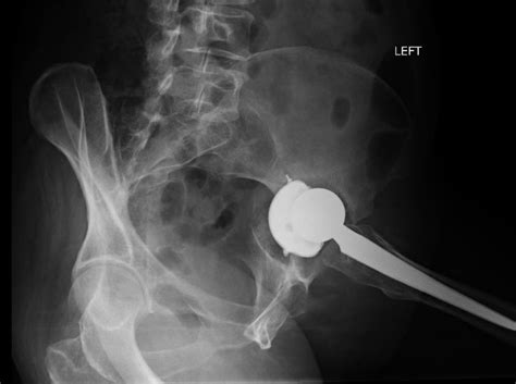 Pelvic Discontinuity Darwin Chen Md