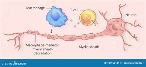 Multiple Sclerosis Anatomical Vector Illustration Diagram Medical Scheme Vector Illustration