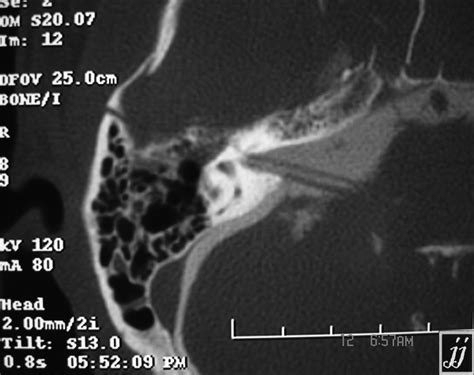 Frontal Sinus Fracture Cisternography Radiopaedia
