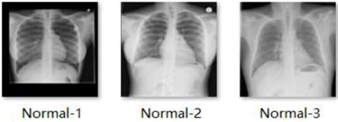 論文レビュー Distributed U Net Model And Image Segmentation For Lung Cancer Detection
