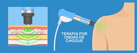 Como A Terapia Por Ondas De Choque Pode Aliviar A Dor Crônica Dr