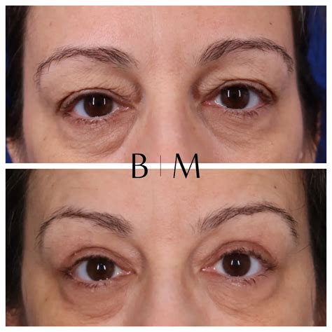Eyelid Surgery In Manhattan Blepharoplasty In New York City