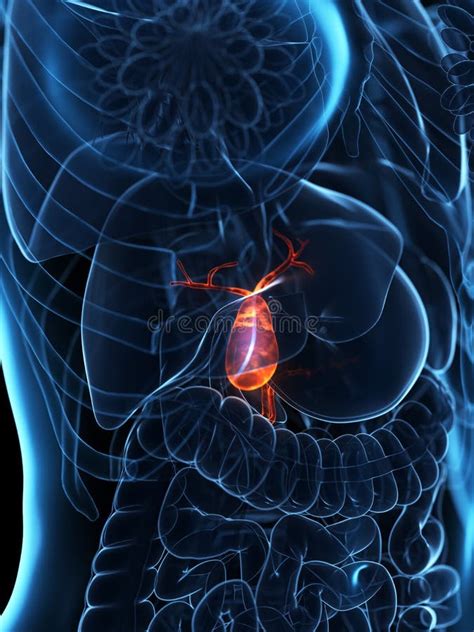 A Diseased Gallbladder Stock Illustration Illustration Of Diseased