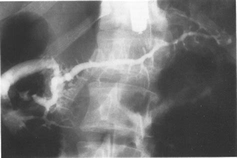 Film Ofresult Ofsingle Injection At Minor Papilla After Major Papilla Download Scientific