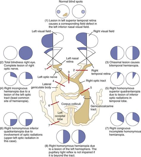 Visual Loss Neupsy Key