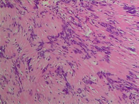 Surgical Specimen Tumor Cells Are Spindle Shaped And Fenestrated With