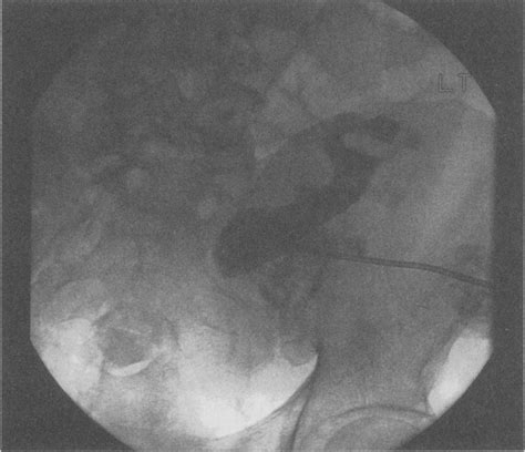 This Percutaneous Nephrostogram Demonstrates The Collecting System Of Download Scientific