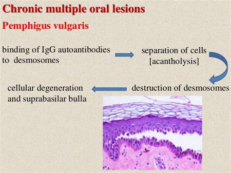 Ulcerative Lesions