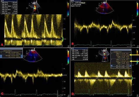 Diastolic Function In Patient With Af American College Of Cardiology