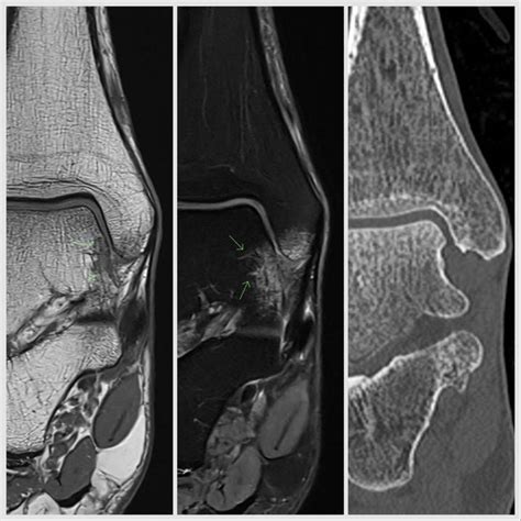 Enhanced Detection Of Microtrabecular Fractures Using 3t Mri With Deep