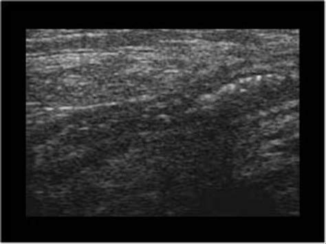 Abdomen And Retroperitoneum 1 5 Appendix Case 1 5 2 Uncomplicated