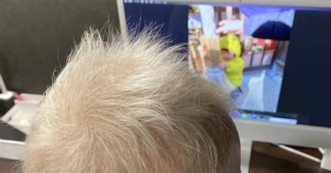 모더나 맞고 대머리된 20대 女 놀라운 근황 보니