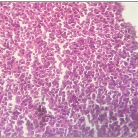 Hande X 40 Showed Sheets Of Plasmacytoid Cells And Few Plasmoblasts