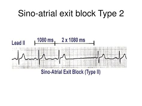 Ppt Ekg Conduction Abnormalities Part Ii Powerpoint Presentation