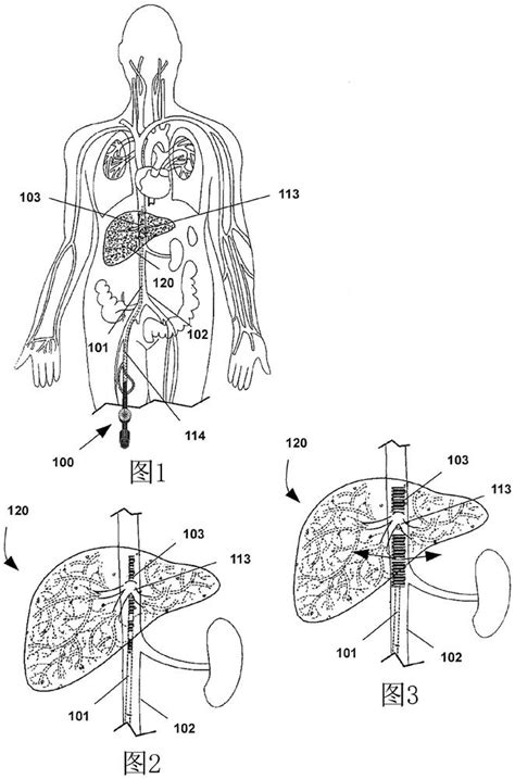 Endoprosthesis For A Total Vascular Exclusion Of The Liver Eureka