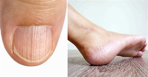 تغییر شکل ناخن‌ها نشانه چیست؟ هشداری که باید جدی گرفت خبرآنلاین