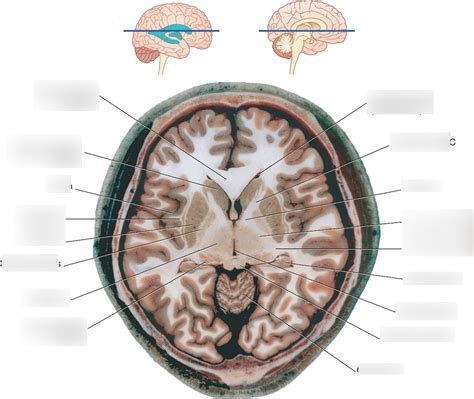 Coronal Section Of The Brain Diagram Quizlet
