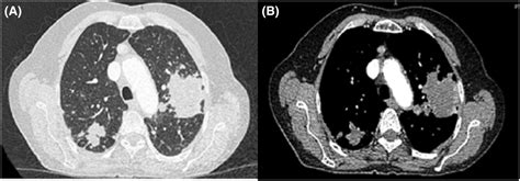 Proteus Mirabilis A Rare Cause Of Pneumonia Radiologically Mimicking