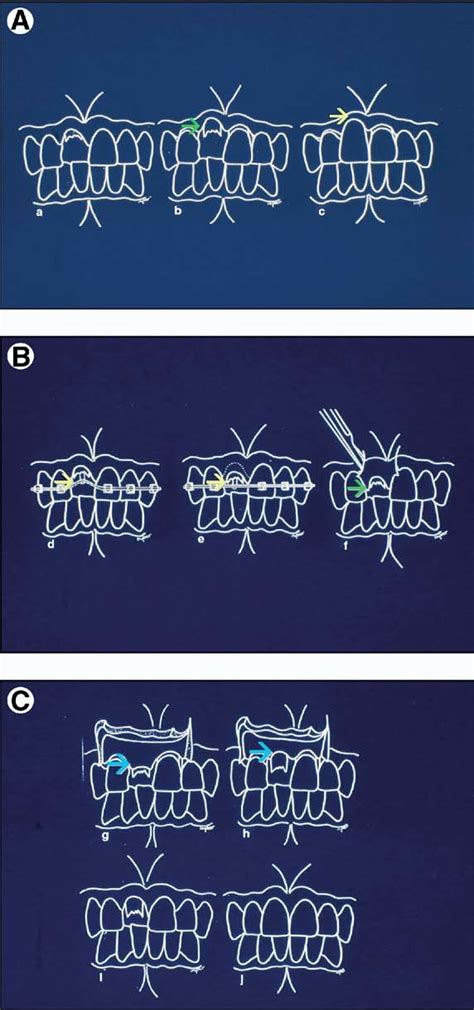 A Crown Lengthening With Surgery Only Note The Inconsistent Gingival Download Scientific