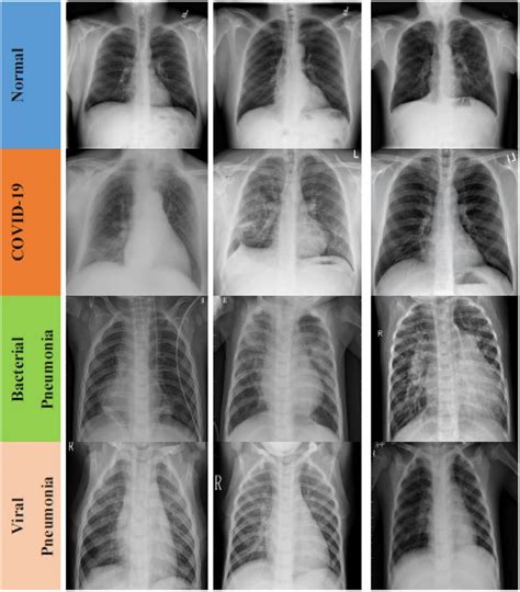 Normal Chest X Ray Vs Pneumonia