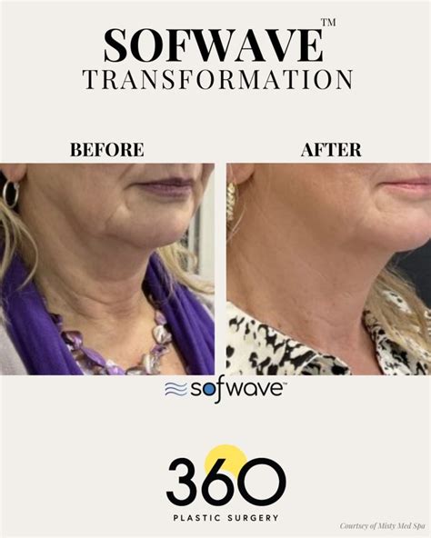 Sofwave Archives — 360 Plastic Surgery