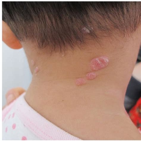 Distribution And Infiltration Of Erythematous Macules With Scales On