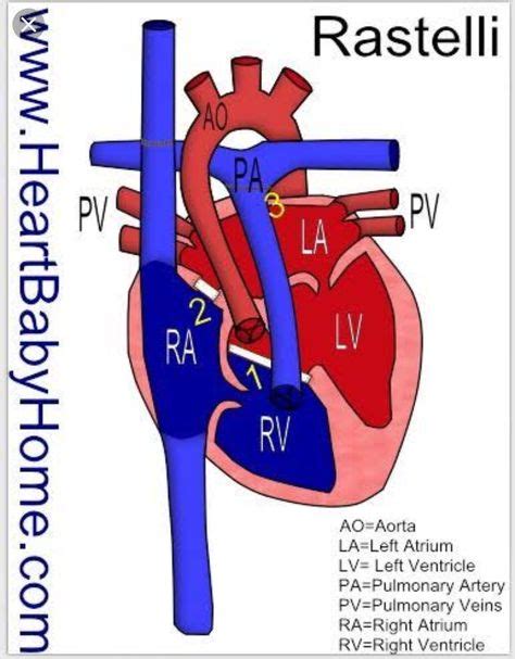 Rastelli Procedure