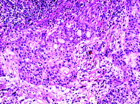 Photomicrograph Showing Malignant Epidermoid Cells Intermediate Cells