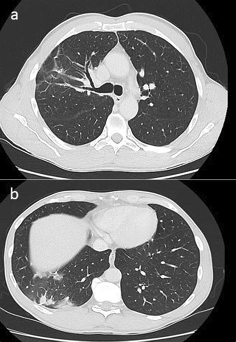 Axial Slices Of Computed Tomography Chest 6 Months Post Sabr