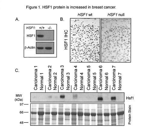 Hsf1 As A Marker In Tumor Prognosis And Treatment Eureka Patsnap