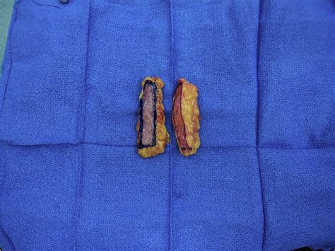 Figure 1 From Use Of Dermal Fat Graft For Augmentation Of The Labia