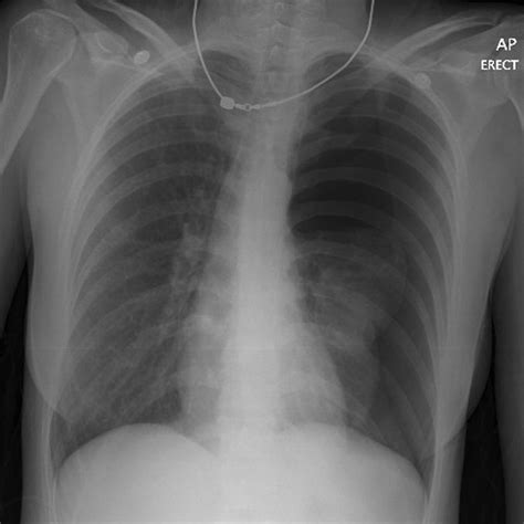 Left Pneumothorax X Ray