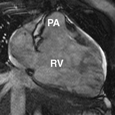 Extent Of Mri Delayed Enhancement Of Myocardial Mass Is Related To
