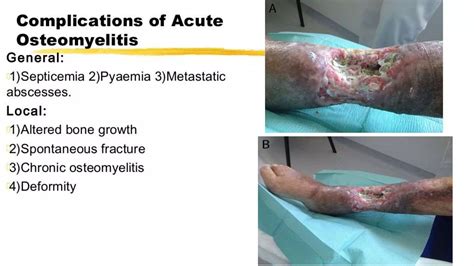 Acute Osteomyelitis Pptpptx