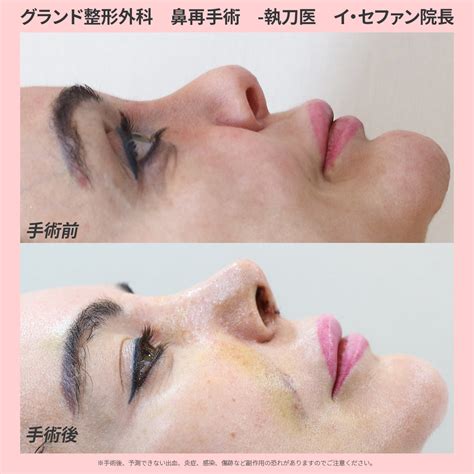 グランド整形外科 鼻再手術 グランド整形外科