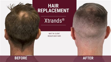 Top 100 How To Cover Hair Loss Polarrunningexpeditions