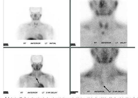 Figure 1 From Severe Hypercalcemia Due To Primary Hyperparathyroidism