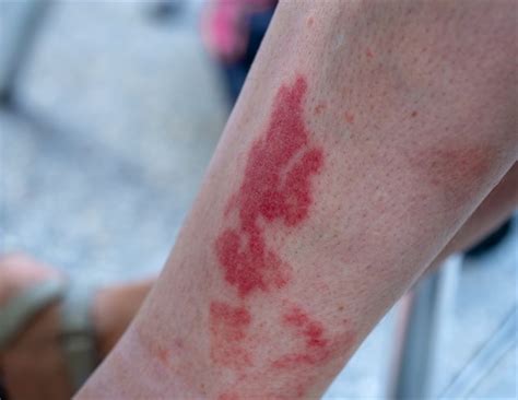 Livedoid Vasculopathy Livedoid Vasculitis