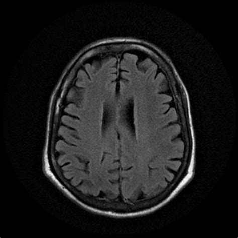 Atrofia Cerebral A Os Diagnostico Org