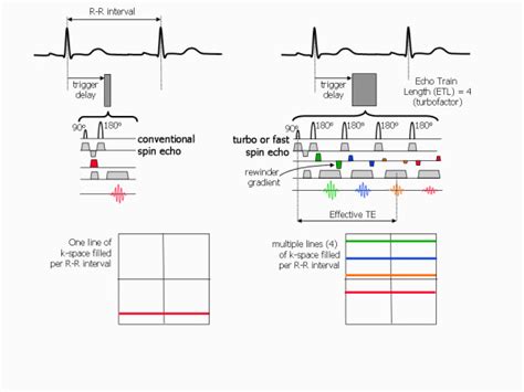 Accelerated Spin Echo Imaging With Turbo Or Fast Spin Echo The