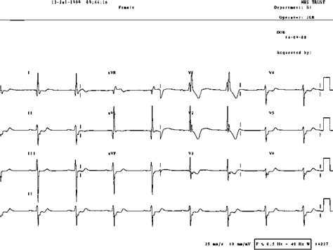 Trifascicular Block Ecg Findings At Cynthia Goldsmith Blog
