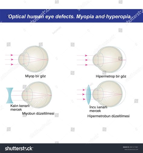 Anatomical Structure Defects Human Eye Human Stock Vector Royalty Free 2001217481 Shutterstock