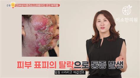 이것도 스테로이드 때문 사진으로 보는 스테로이드 부작용 And 해결법 이소한의원