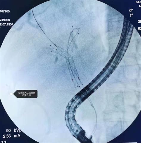 分享一例ercp胆道支架置入术胆胰内镜网