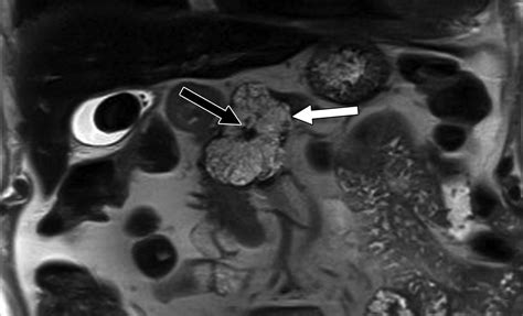 Pancreatic Calcifications And Calcified Pancreatic Masses Pattern Recognition Approach On Ct Ajr