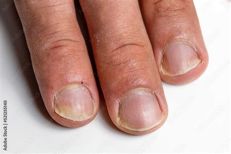 Hand And Fingers With Psoriatic Onychodystrophy Or Psoriatic Nails