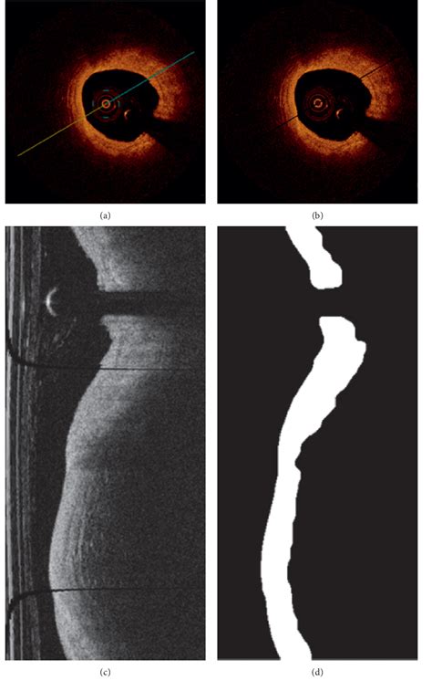 Figure 3 From Fully Automated Lumen Segmentation Method For