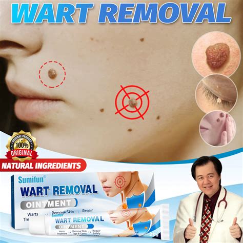 Warts Remover Cream Kasoy Oil Cream Warts Removal Wart Remover Genital