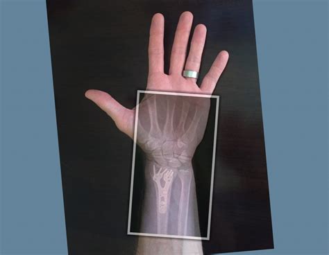Distal Radius Fracture Care In Raleigh Nc John Erickson Md
