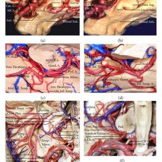 A Medial View Of The Anterior Segment Of The Medial Temporal Region